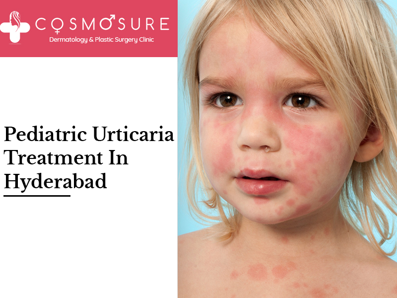 Pictures Of Hives On Kids Infoupdate Pictures Of Hives On Kids Infoupdate