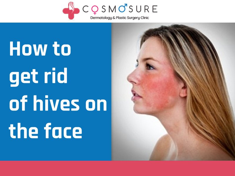 Hives On Face Baby Hives Causes Symptoms Treatments Mustela Usa Hives On Face Baby Hives Causes Symptoms Treatments Mustela Usa